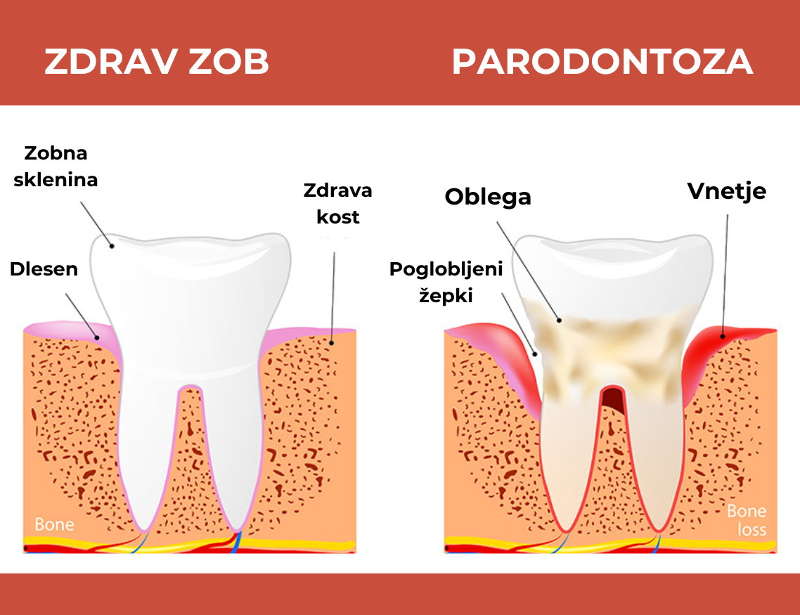 Ugotovite svojo stopnjo obolelosti s parodontozo. | Klinika Krizaj ...